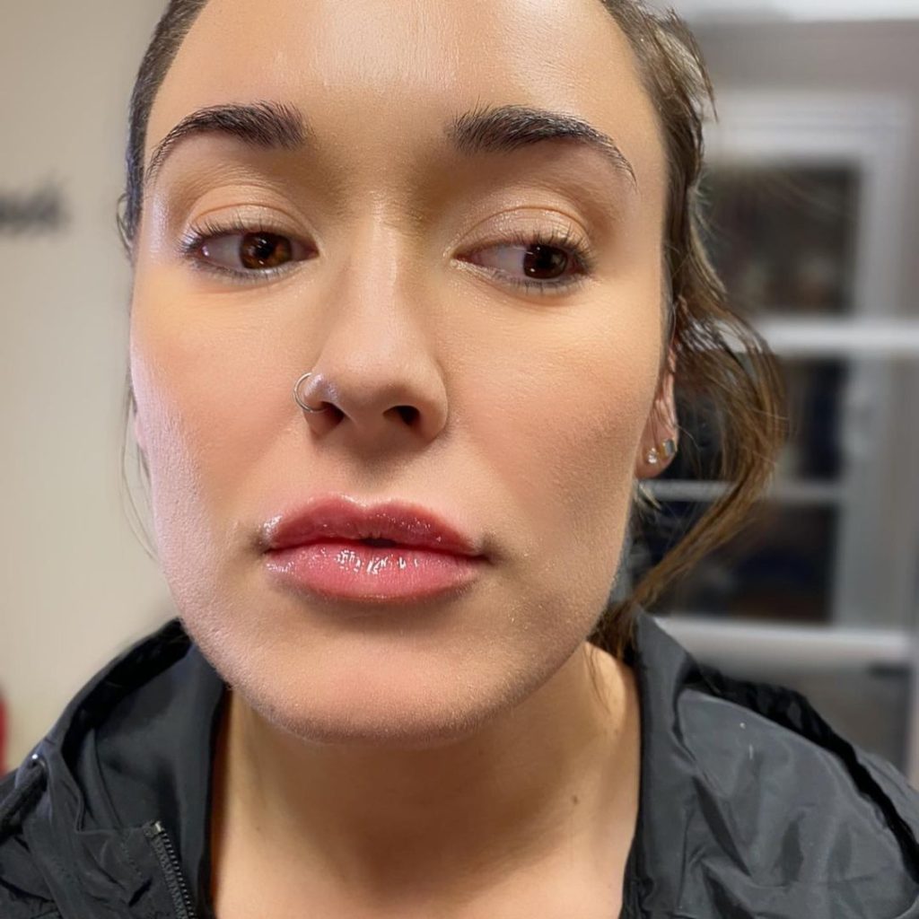 Needleless lip filler - meistergaret